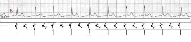 ECG Challenge: Grouped Beating - Double Tachycardia - ANSWER | ECG Guru ... ECG Challenge: Grouped Beating - Double Tachycardia - ANSWER | ECG Guru ...